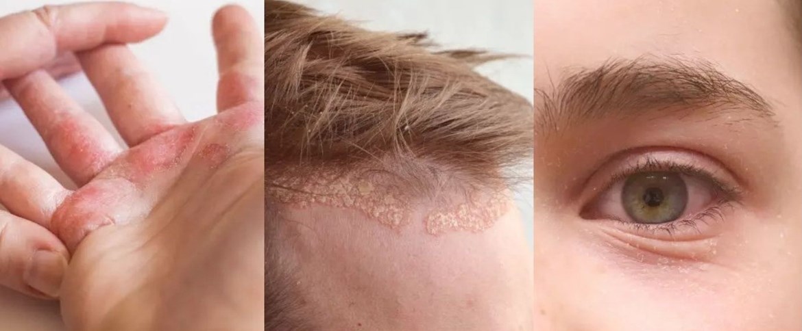 3 Types of Dermatitis and How to Treat Them - SweetCare Peru