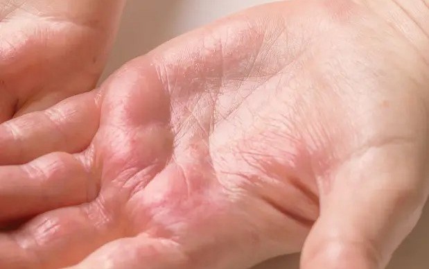3 Types of Dermatitis and How to Treat Them SweetCare Philippines