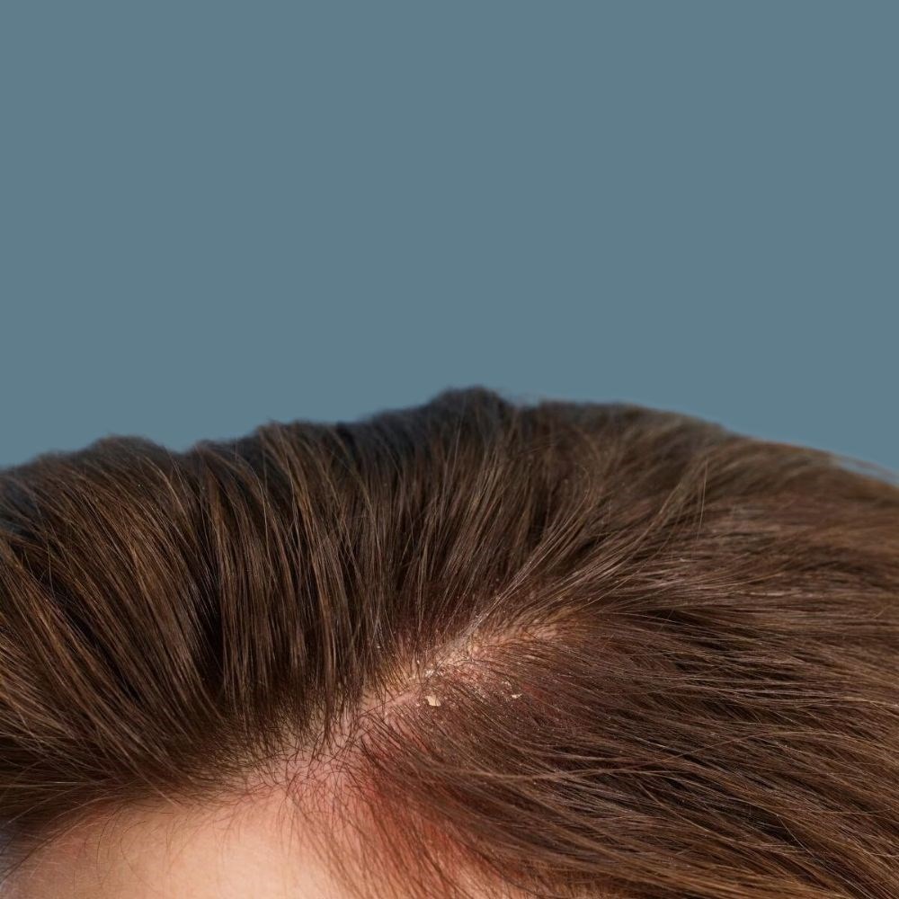 Dandruff or Seborrheic Dermatitis? Ducray Solutions - SweetCare Latvia