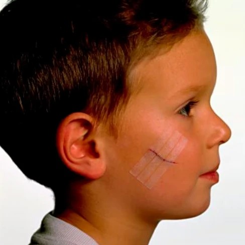 Steri-Strip Sutura adhesiva - SweetCare Uruguay