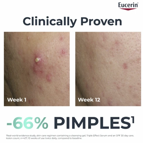 Eucerin DermoPure Clinical Triple Effect Serum Post-Acne Marks ...