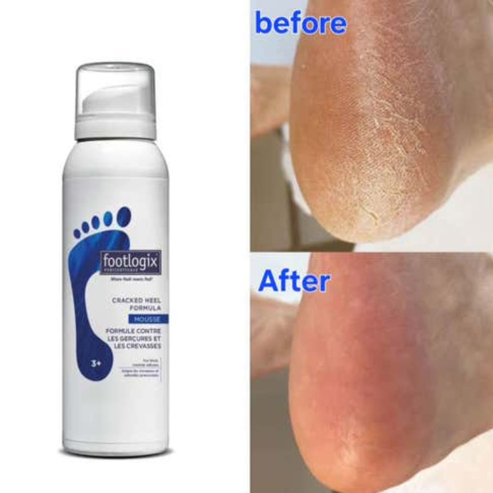 Footlogix Cracked Heel Formula Mousse - SweetCare Uzbekistan